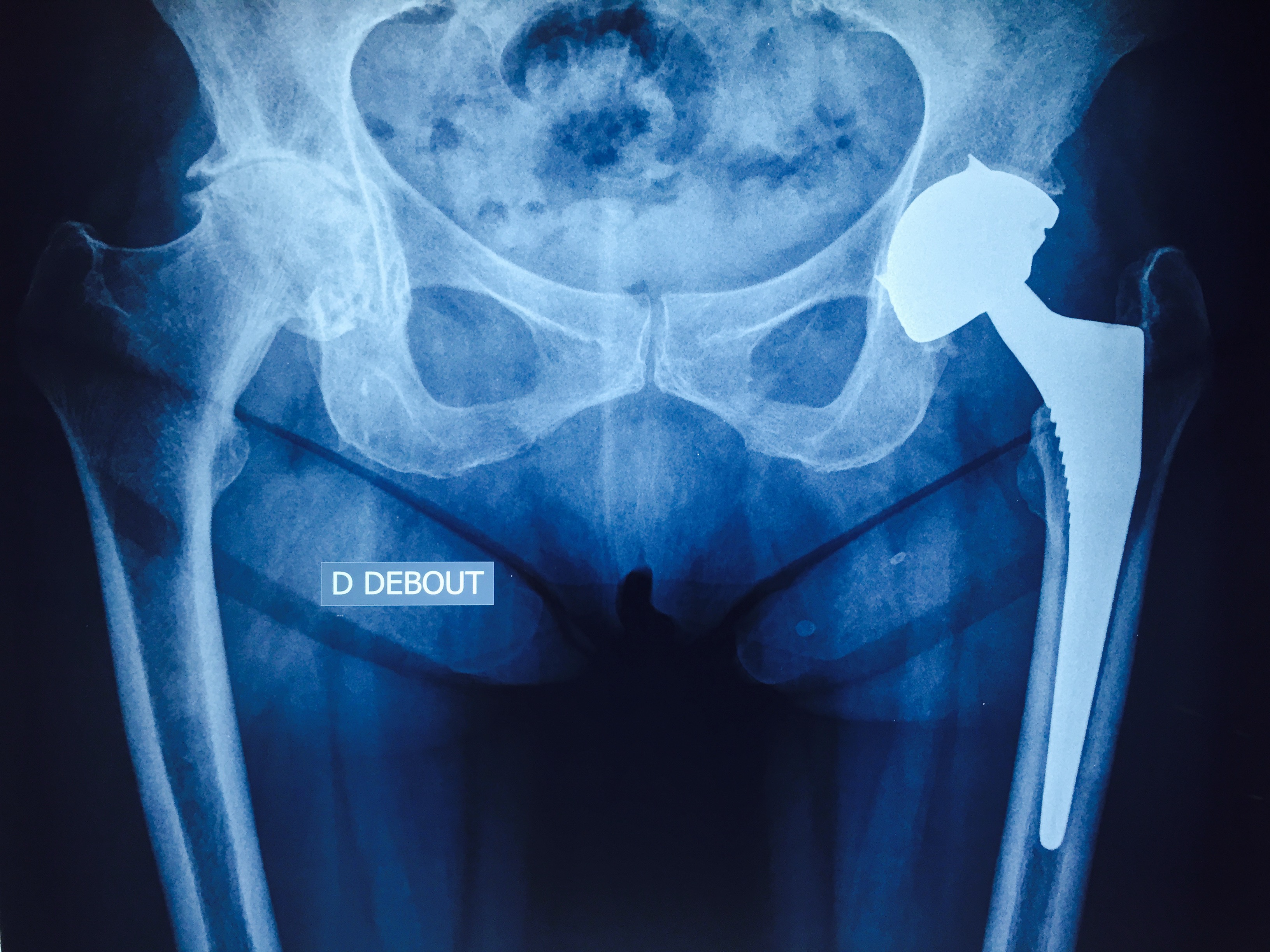 COXARTHROSE - Institut Chirurgie Orthopédique Nantes Atlantique